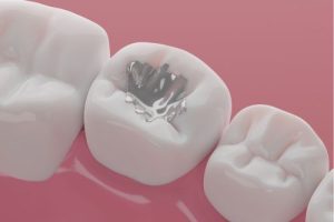 Pros And Cons Of A Dental Filling