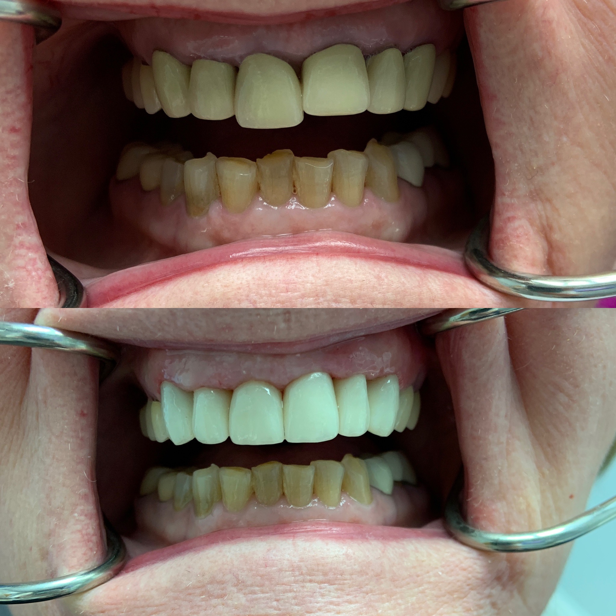 What Is The Most Common Type Of Dental Restoration